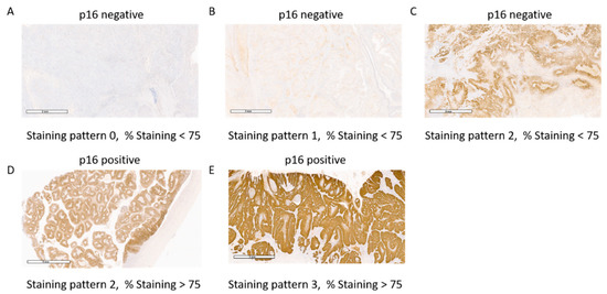 Cancers | Free Full-Text | Prognostic Significance of p16 and Its ...