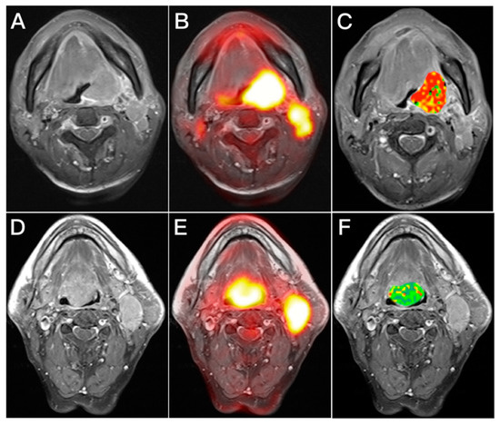 Prospective Investigation of 18FDG-PET/MRI with Intravoxel Incoherent ...