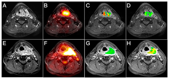 Prospective Investigation of 18FDG-PET/MRI with Intravoxel Incoherent ...
