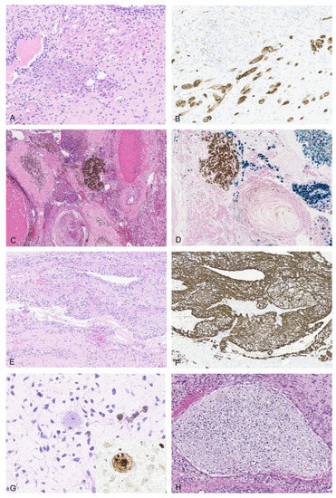 Teratoid Hepatoblastoma—Our Experience