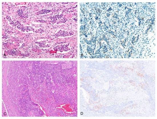 Teratoid Hepatoblastoma—Our Experience