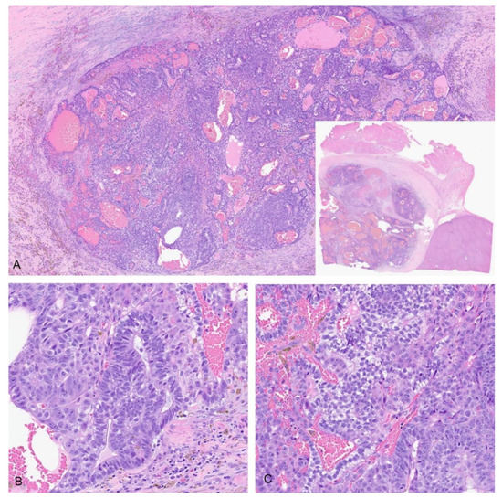 Teratoid Hepatoblastoma—Our Experience