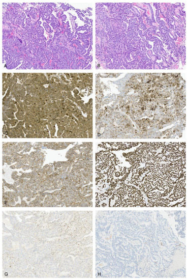 Teratoid Hepatoblastoma—Our Experience