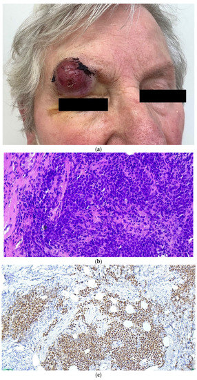 Cancers | Free Full-Text | Epidemiology of Merkel Cell Polyomavirus ...