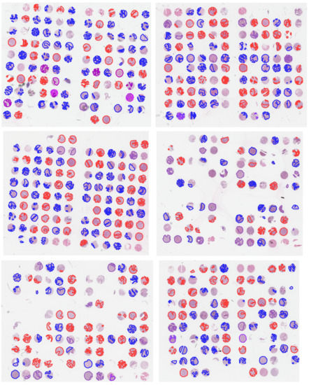Multimodal Lung Cancer Subtyping Using Deep Learning Neural Networks on ...