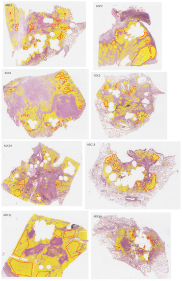 Multimodal Lung Cancer Subtyping Using Deep Learning Neural Networks on ...
