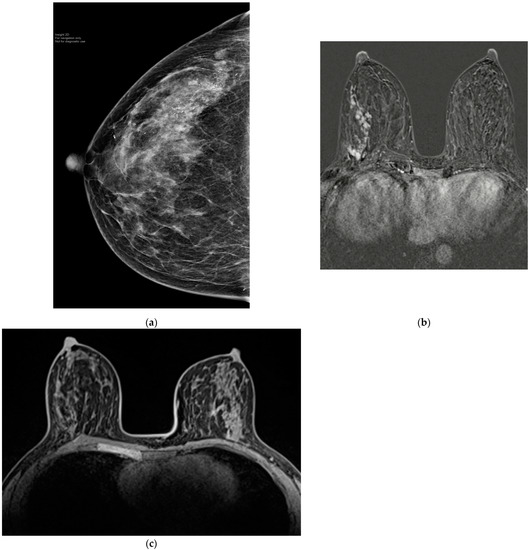 Pathologic Response of Associated Ductal Carcinoma In Situ to ...