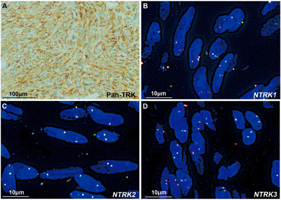 Cancers | Free Full-Text | GISTs with NTRK Gene Fusions: A ...