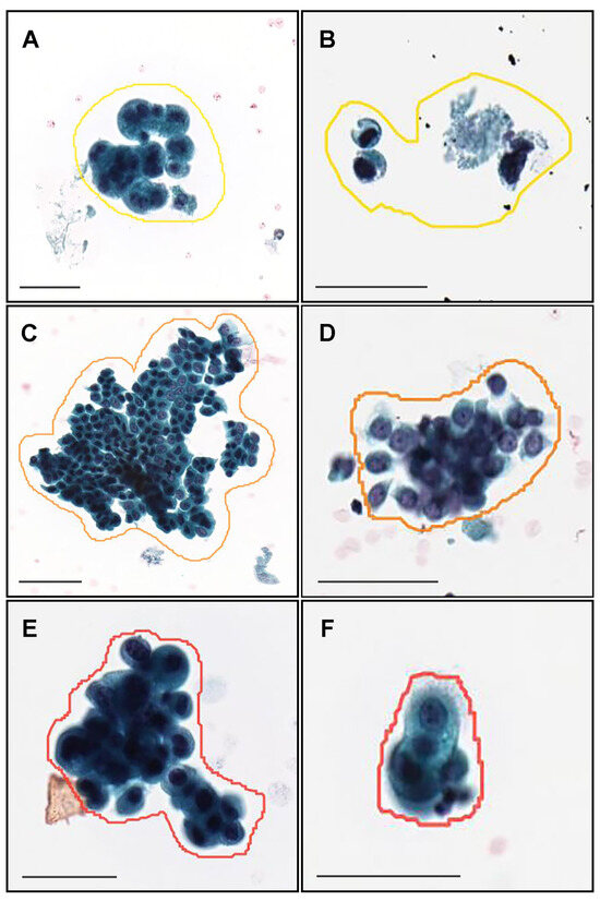 Deep Learning-Based Screening of Urothelial Carcinoma in Whole Slide ...