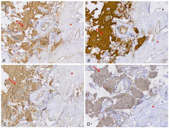 Protoporphyrin IX (PpIX) Fluorescence during Meningioma Surgery ...