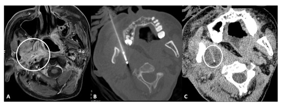 Emerging Indications for Interventional Oncology: Expert Discussion on ...
