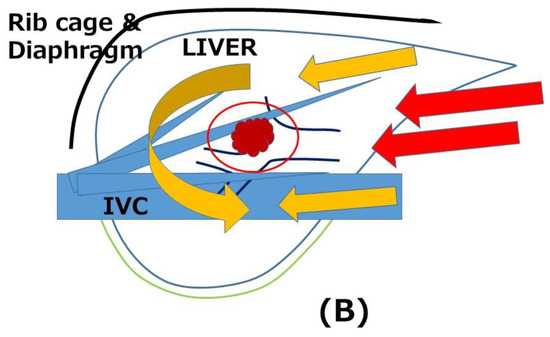 Laparoscopic Repeat Liver Resection—Selecting the Best Approach for ...