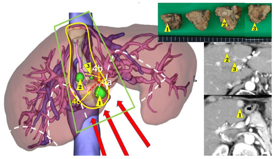 Laparoscopic Repeat Liver Resection—Selecting the Best Approach for ...