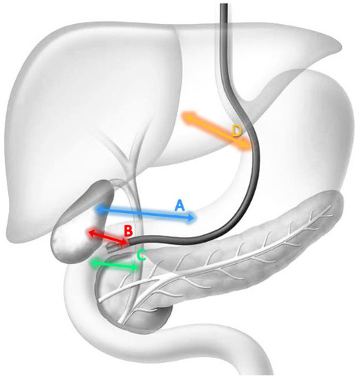 Endoscopic Ultrasound Guided Biliary Drainage in Malignant Distal ...