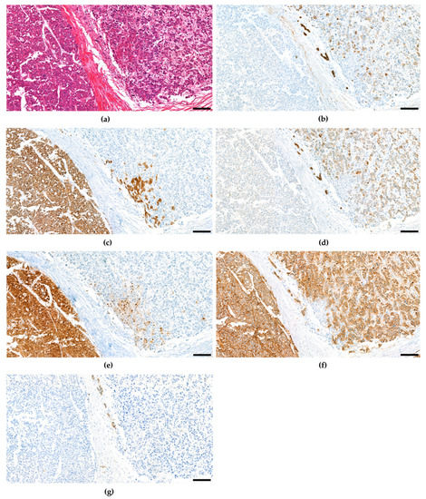 Cancers | Free Full-Text | Pathology of Combined Hepatocellular Carcinoma-Cholangiocarcinoma: An ...
