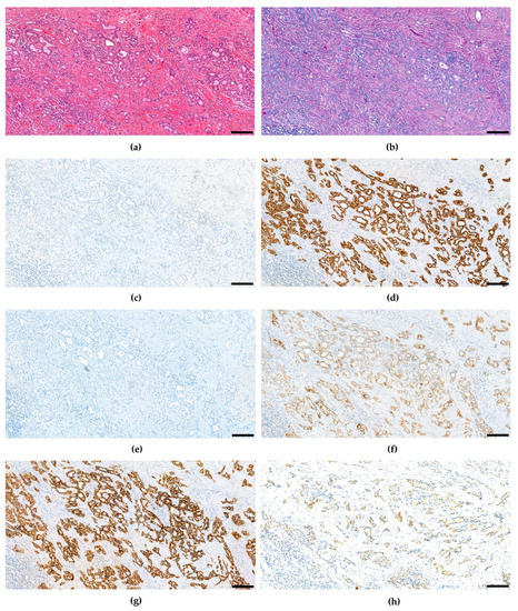 Pathology of Combined Hepatocellular Carcinoma-Cholangiocarcinoma: An ...