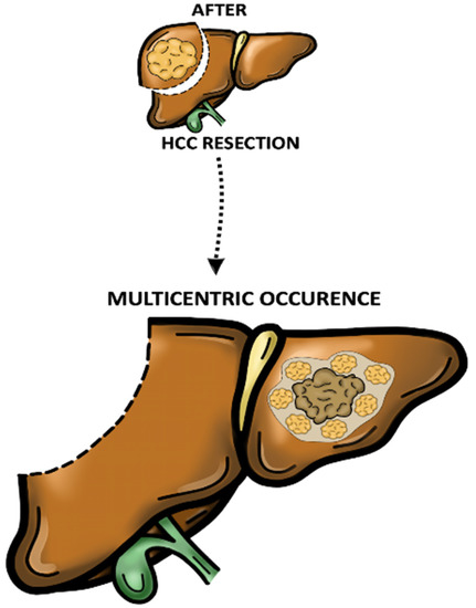 Surgical Strategies for Recurrent Hepatocellular Carcinoma after ...