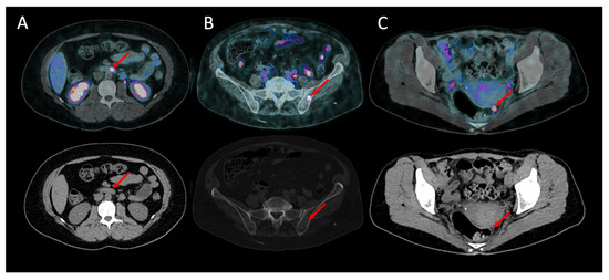 Prospective Multicentric Assessment of 68Ga-DOTANOC PET/CT in Grade 1-2 ...