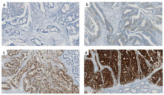 Cancers | Free Full-Text | Distinct Clinicopathological Features and ...
