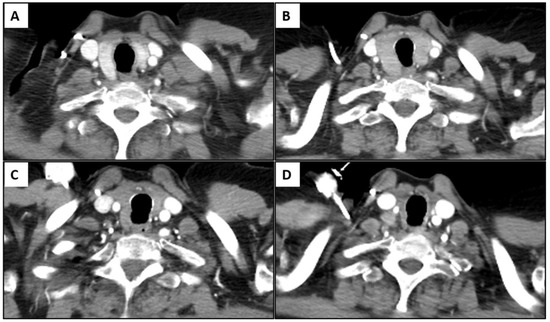 Immune-Related Thyroiditis in Patients with Advanced Lung Cancer ...