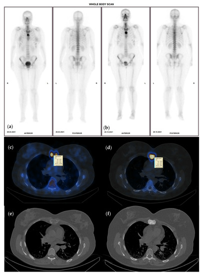 Quantitative Assessment of Treatment Response in Metastatic Breast ...
