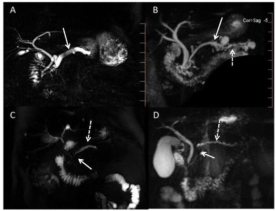 Pancreatic Cancer in Chronic Pancreatitis: Pathogenesis and Diagnostic ...