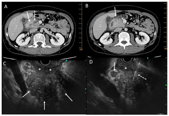 Pancreatic Cancer in Chronic Pancreatitis: Pathogenesis and Diagnostic ...