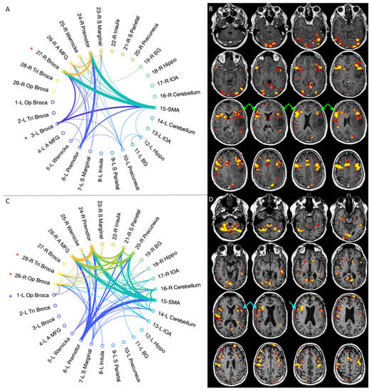 Longitudinal Evaluation of Brain Plasticity in Low-Grade Gliomas: fMRI ...