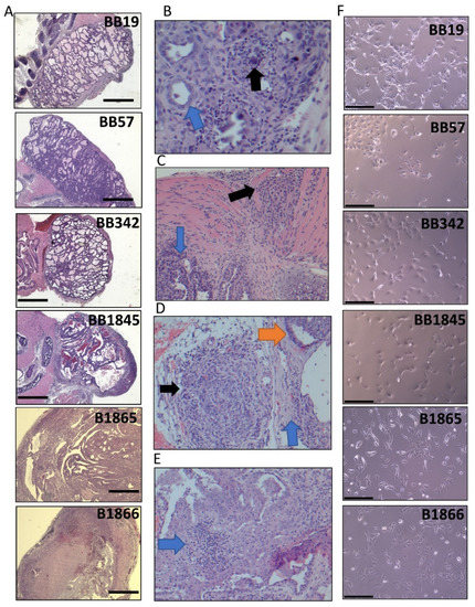 Cancers | Free Full-Text | Development of Novel Murine BRAFV600E-Driven Papillary Thyroid Cancer ...