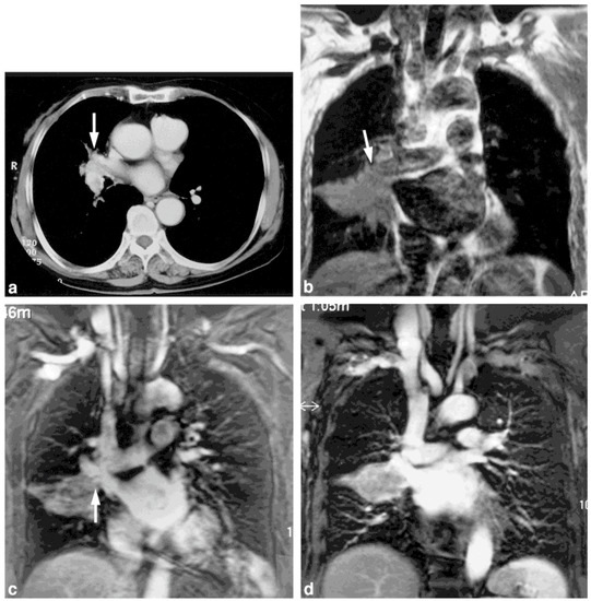 State of the Art MR Imaging for Lung Cancer TNM Stage Evaluation