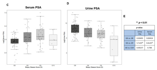 Urinary PSA and Serum PSA for Aggressive Prostate Cancer Detection
