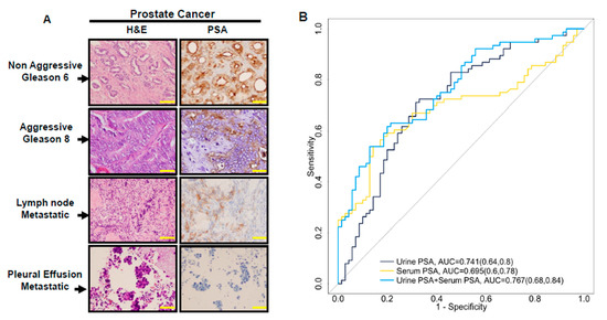 Urinary PSA and Serum PSA for Aggressive Prostate Cancer Detection