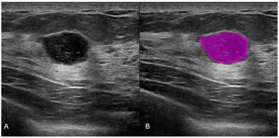 Prediction of the Malignancy of a Breast Lesion Detected on Breast ...