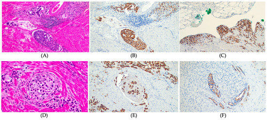 MUC1 Expressions and Its Prognostic Values in US Gastric Cancer Patients