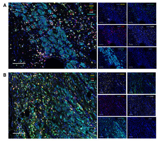 CXCR3 Expression Is Associated with Advanced Tumor Stage and Grade ...