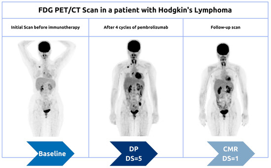 FDG-PET/CT in the Monitoring of Lymphoma Immunotherapy Response ...