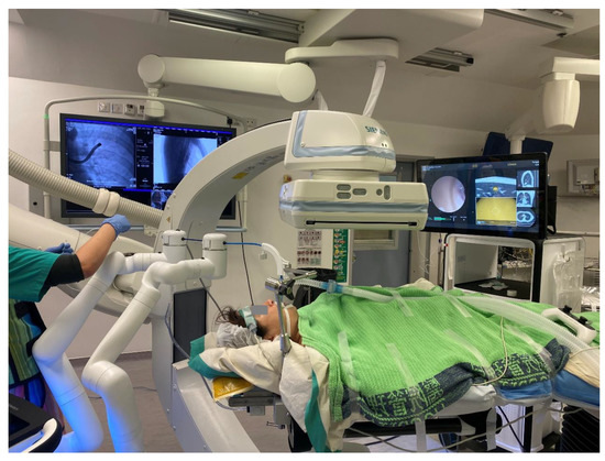 Transbronchial Techniques for Lung Cancer Treatment: Where Are We Now?