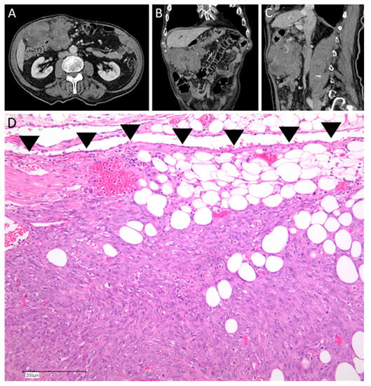 Treatment Pathways and Prognosis in Advanced Sarcoma with Peritoneal ...