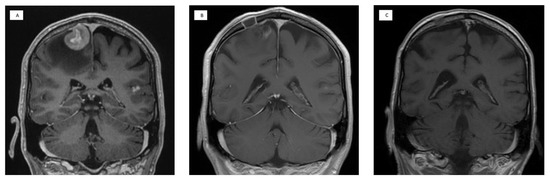 Blood–Brain Barrier Disruption (BBBD)-Based Immunochemotherapy for ...