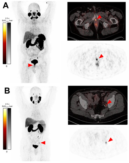 Cancers | Free Full-Text | Detection Efficacy of 68Ga-PSMA-11 PET/CT in ...