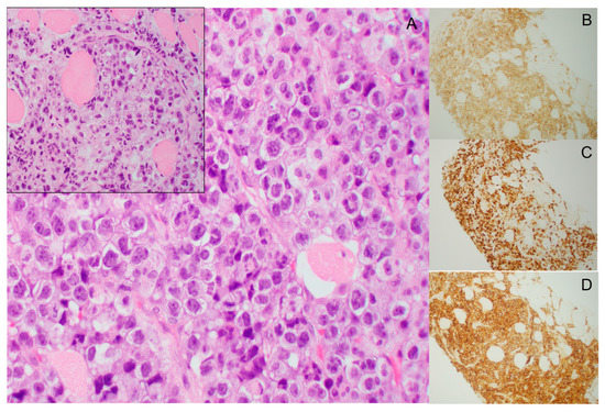 Pediatric Myeloid Sarcoma, More than Just a Chloroma: A Review of ...