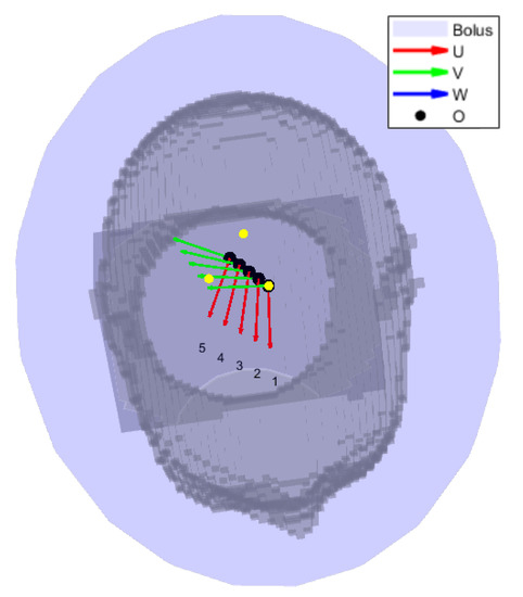Antenna Arrangement in UWB Helmet Brain Applicators for Deep Microwave ...