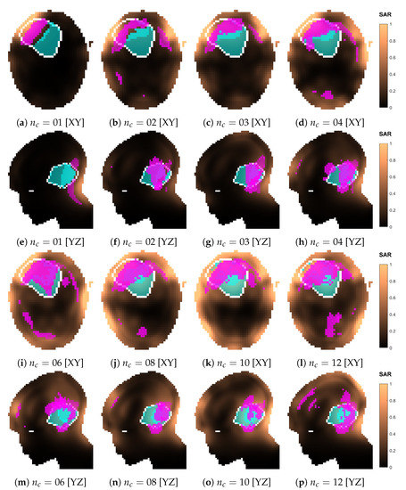 Antenna Arrangement in UWB Helmet Brain Applicators for Deep Microwave ...
