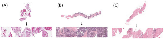 Label Distribution Learning for Automatic Cancer Grading of ...