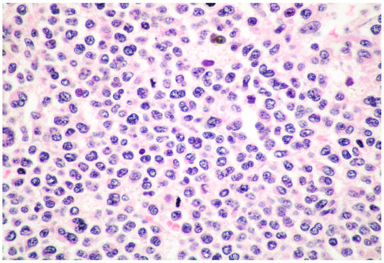 Cancers | Free Full-Text | Mast Cell Leukemia: An Update with a ...