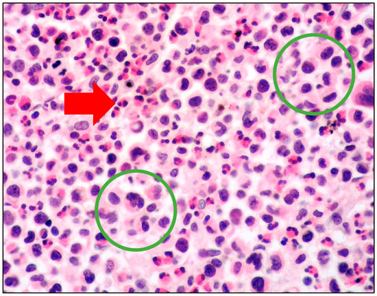 Cancers | Free Full-Text | Mast Cell Leukemia: An Update with a ...