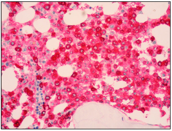 Mast Cell Leukemia: An Update with a Practical Review