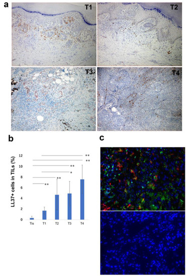 LL-37 Might Promote Local Invasion of Melanoma by Activating Melanoma ...