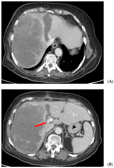 Minimally Invasive ALPPS Procedure: A Review of Feasibility and Short ...