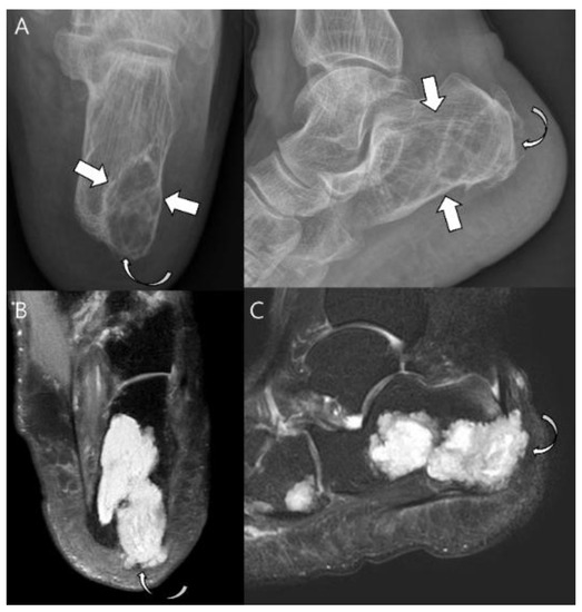 Classification of Chondrosarcoma: From Characteristic to Challenging ...